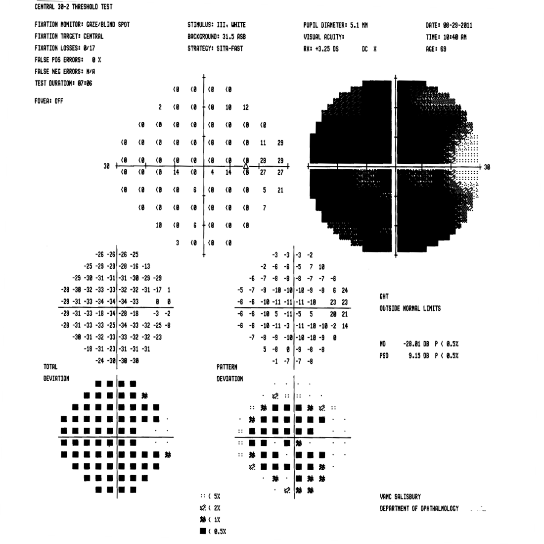 Peripapillary Retinoschisis And Glaucoma Connection A Teaching Case