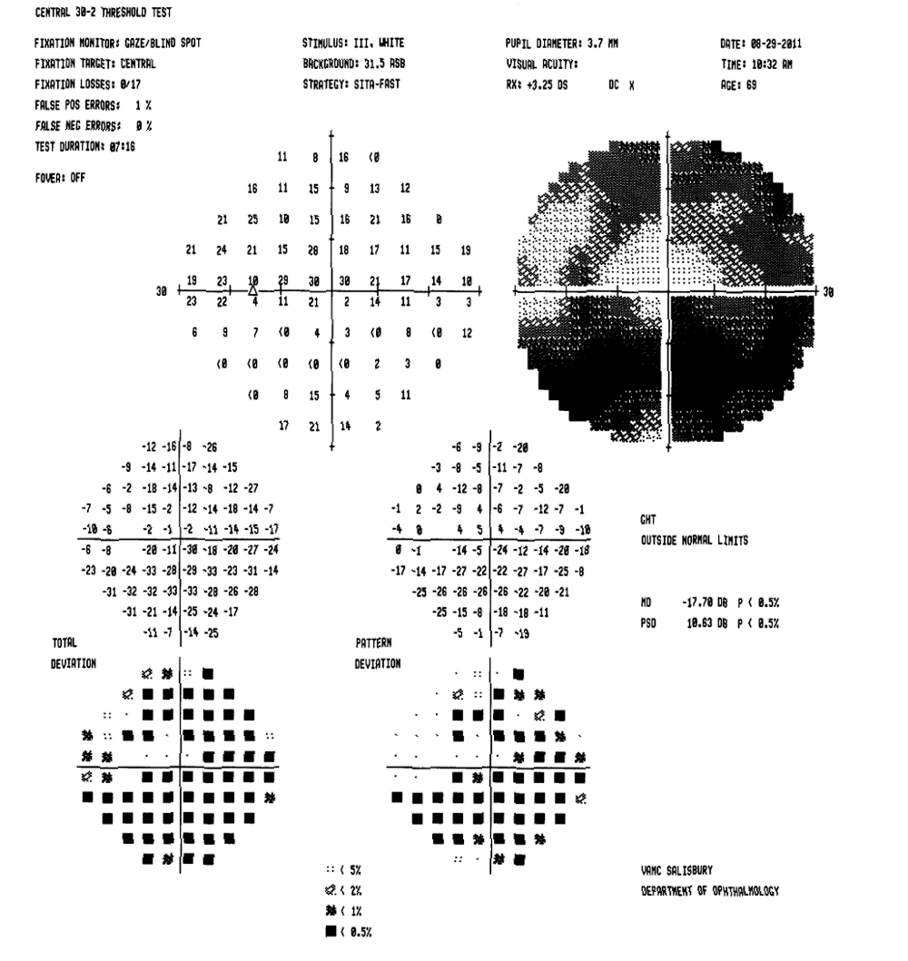 Peripapillary Retinoschisis And Glaucoma Connection A Teaching Case