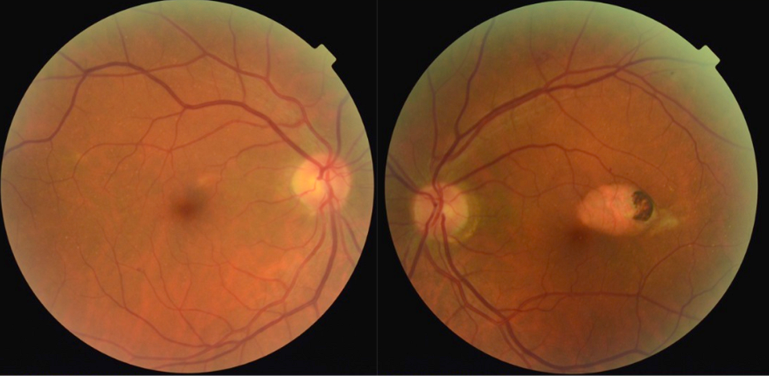Torpedo Maculopathy The Journal Of Optometric Education