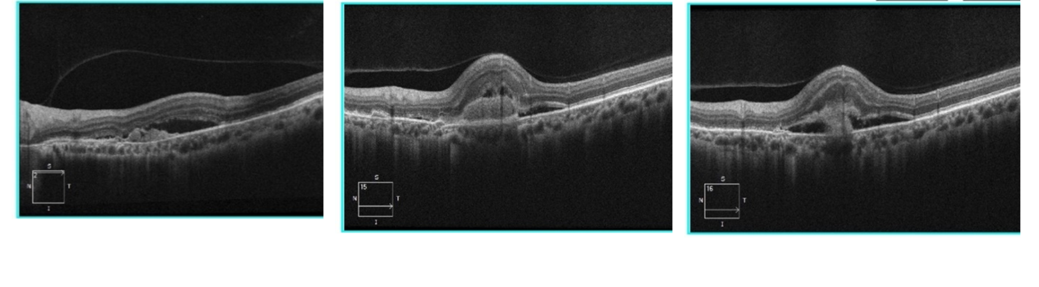 Systemic and Ocular Associations of Angioid Streaks | The Journal of ...
