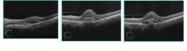 Systemic and Ocular Associations of Angioid Streaks | The Journal of ...