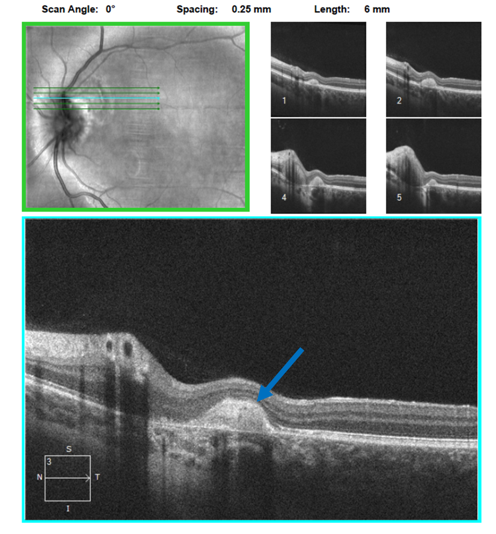 Optic Disc Drusen and Associated Complications:a Teaching Case Report ...