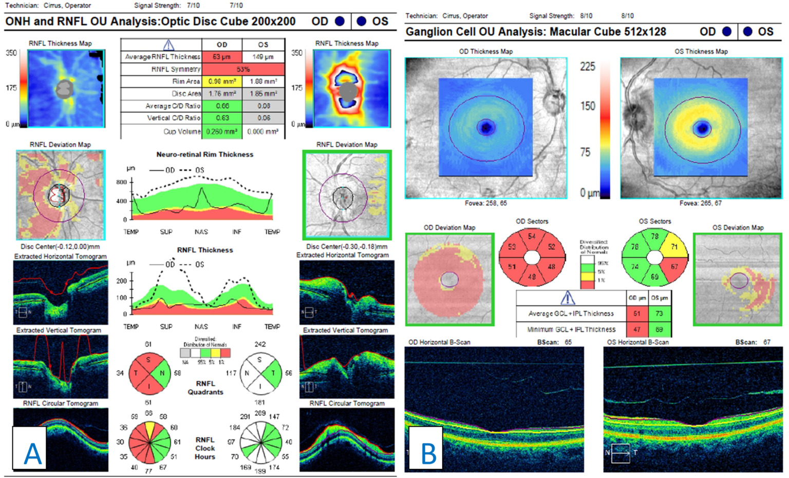 Neuromyelitis Optica Spectrum Disorder and MOGAD Optic Neuritis: a ...