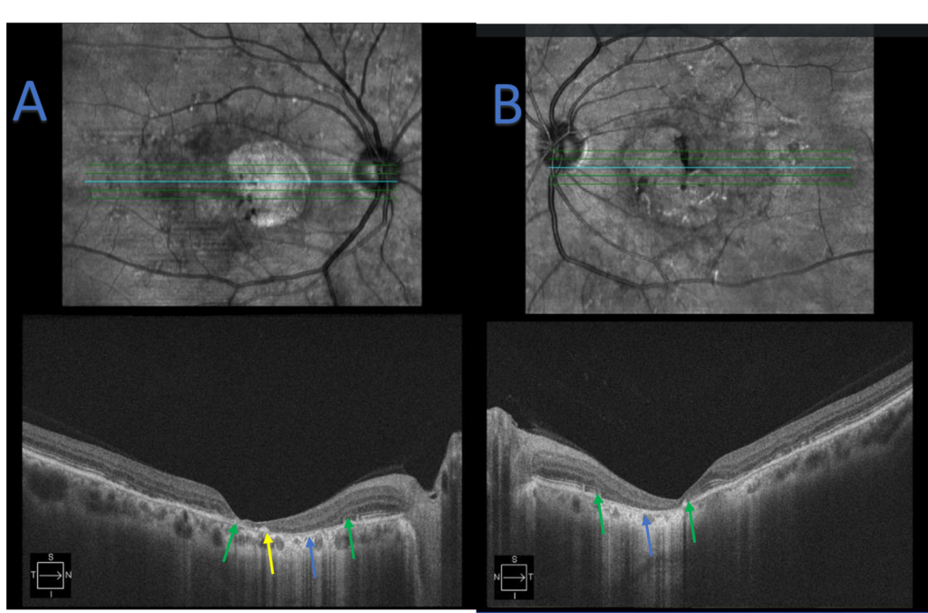 Stargardt Disease: a Teaching Case Series | The Journal of Optometric ...