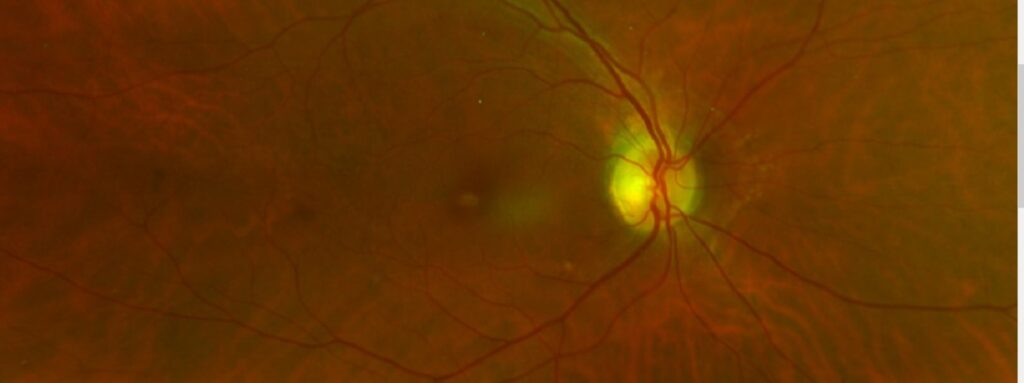 Adult-onset Foveomacular Vitelliform Dystrophy:a Teaching Case Report ...