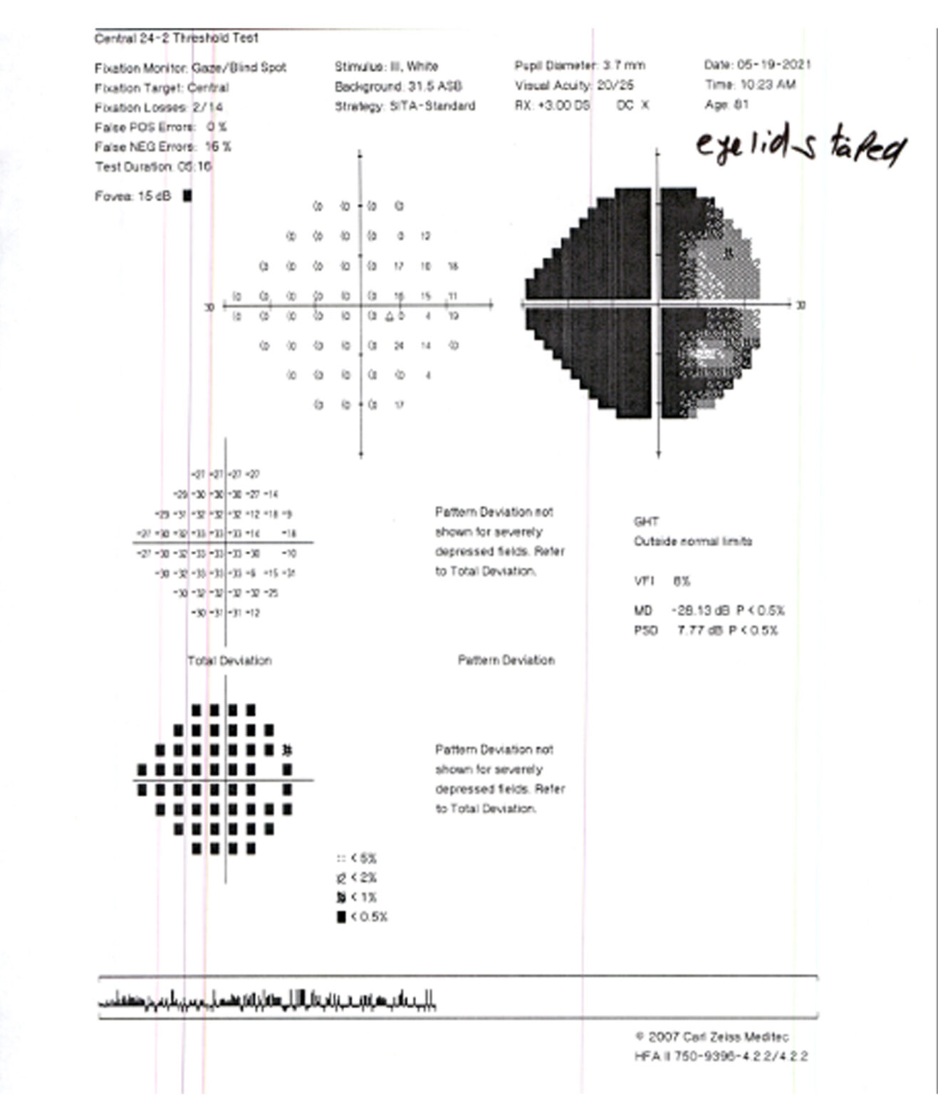 Navigating Visual Field Loss, Visual Neglect, and Ocular Dominance ...