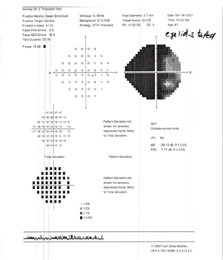 Navigating Visual Field Loss, Visual Neglect, and Ocular Dominance ...