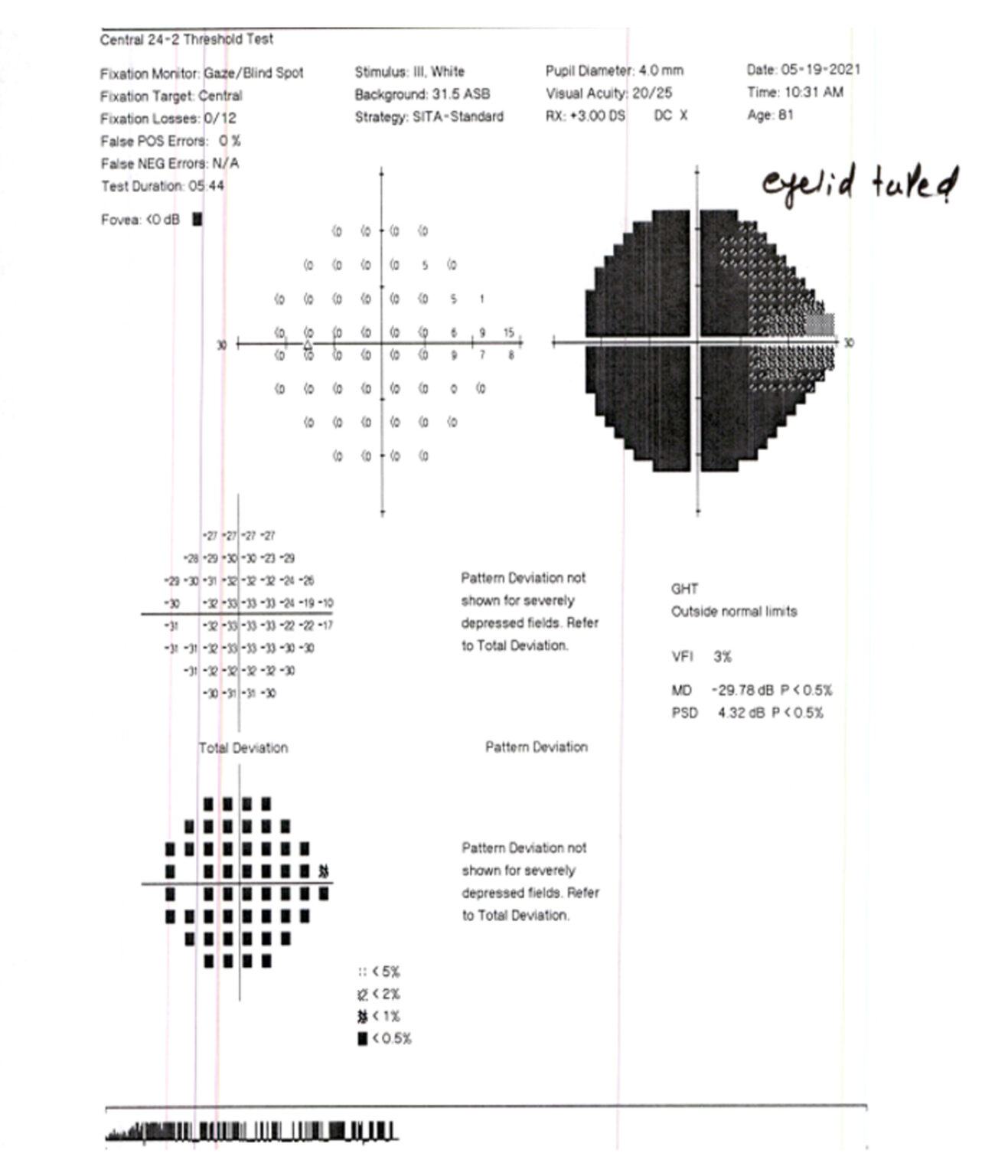 Navigating Visual Field Loss, Visual Neglect, and Ocular Dominance ...