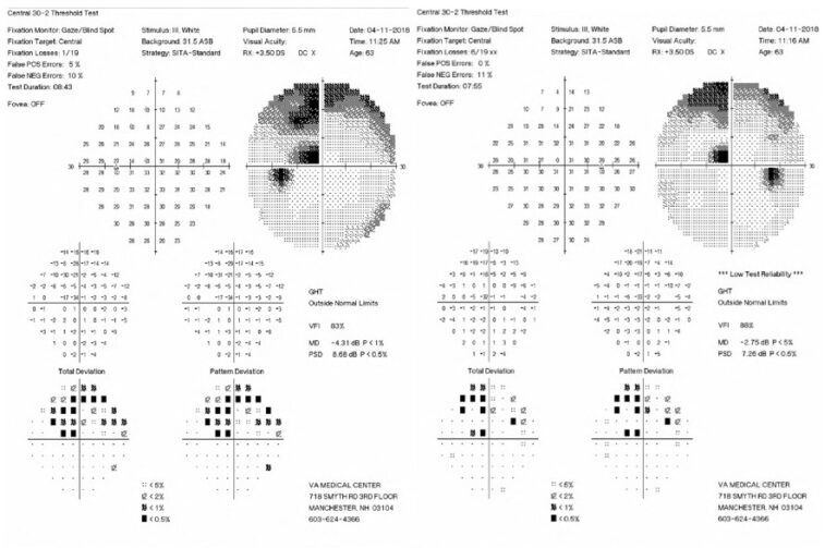 Differentiating Intracranial Pathology Using Visual Fields: a Teaching ...