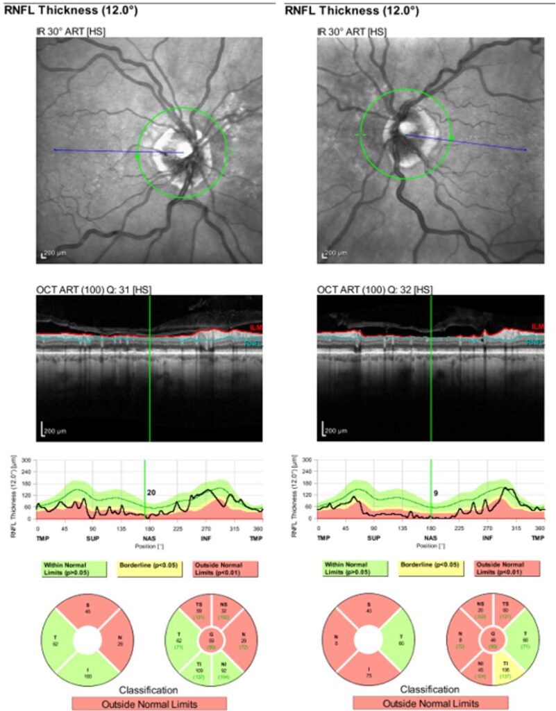 Superior Segmental Optic Nerve Hypoplasia: A Teaching Case Report | The ...