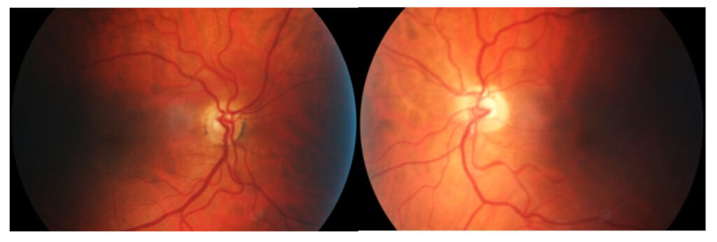 Superior Segmental Optic Nerve Hypoplasia: A Teaching Case Report | The ...